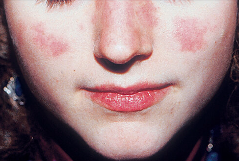 Healing Lupus – Skin Health from Within